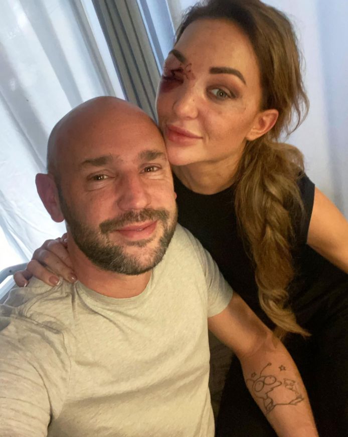 Miss België Chayenne toont voor het eerst zwaar toegetakeld gezicht na ...