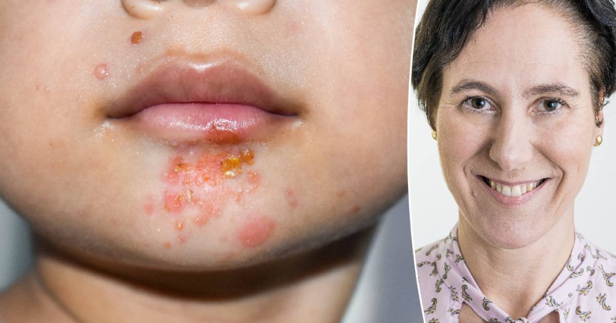 “Impetigo ontstaat door een bacterie die we allemaal op onze huid dragen”: dermatoloog geeft ...