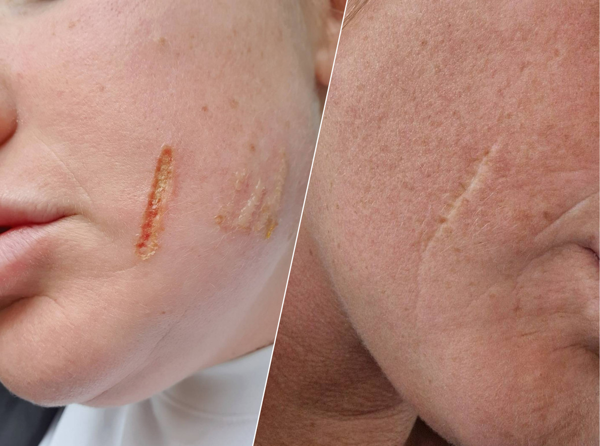 Linde heeft blijvende littekens op haar gezicht door brandwonden na een schoonheidsbehandeling ...