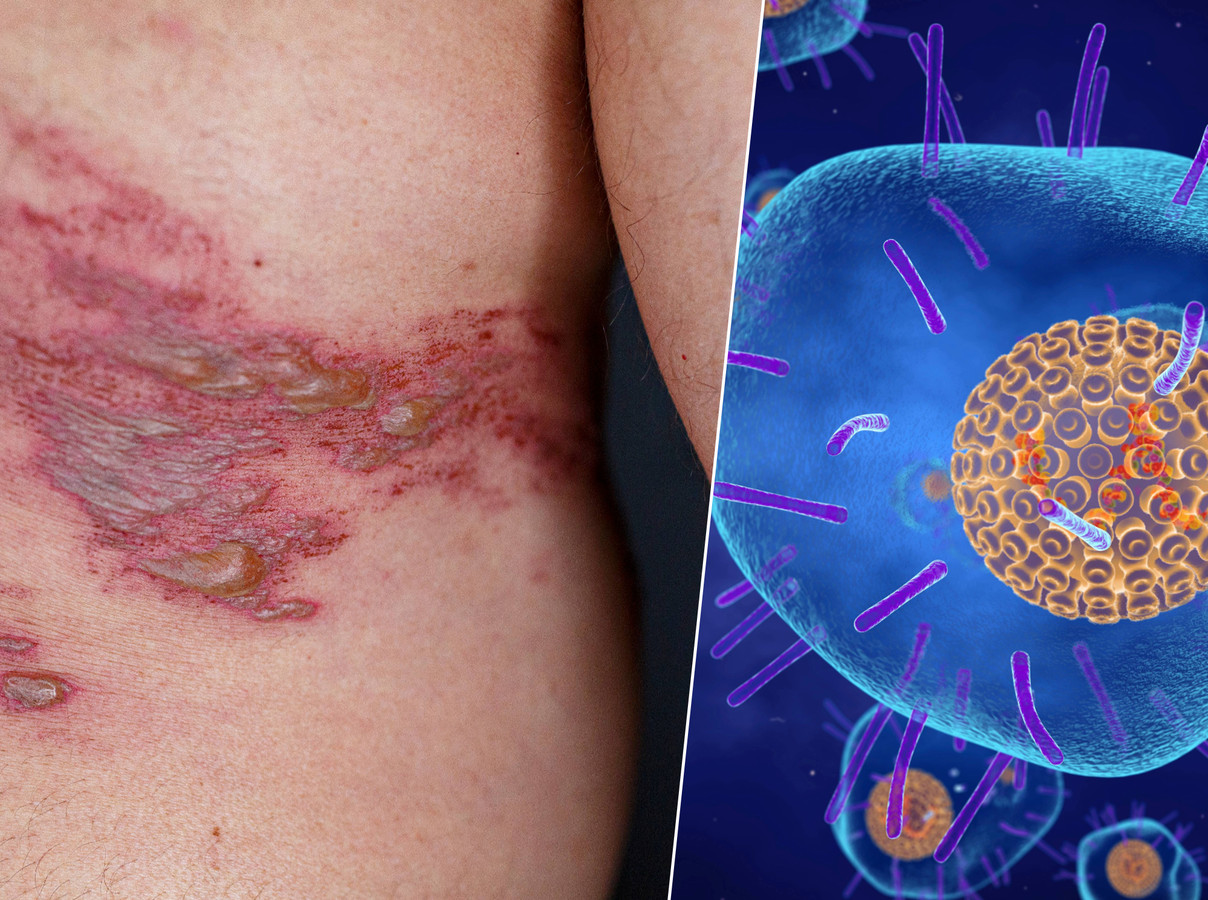 Pijnexpert over gordelroos: ‘Een van de pijnlijkste aandoeningen die je ...