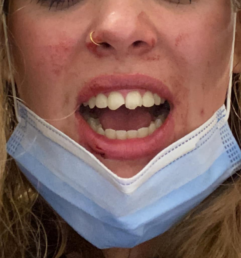 Jongeman slaat bierglas stuk in gezicht van 16-jarig meisje op Oude ...