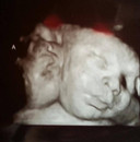 Pasgeboren Siamese tweeling deelt één lichaam | Foto | AD.nl