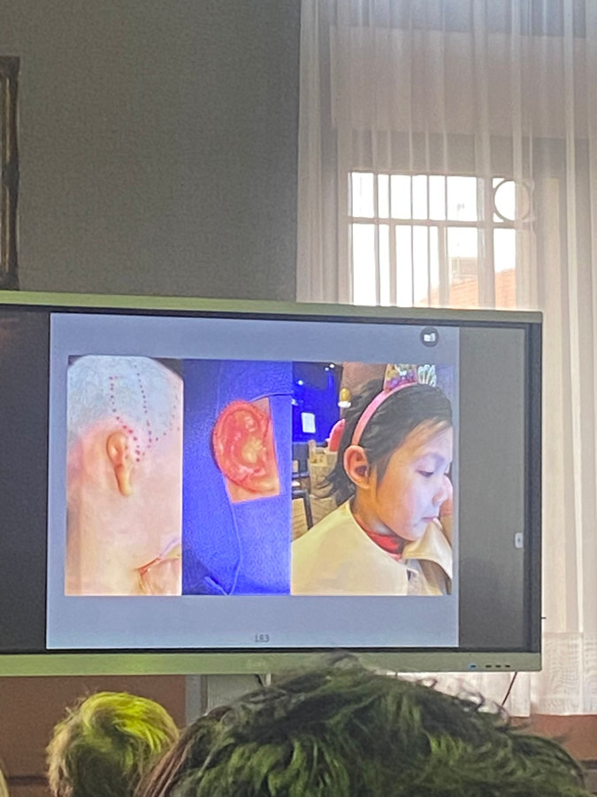 Ouders van Jade (2), het meisje dat zonder oortjes geboren werd, hebben ...