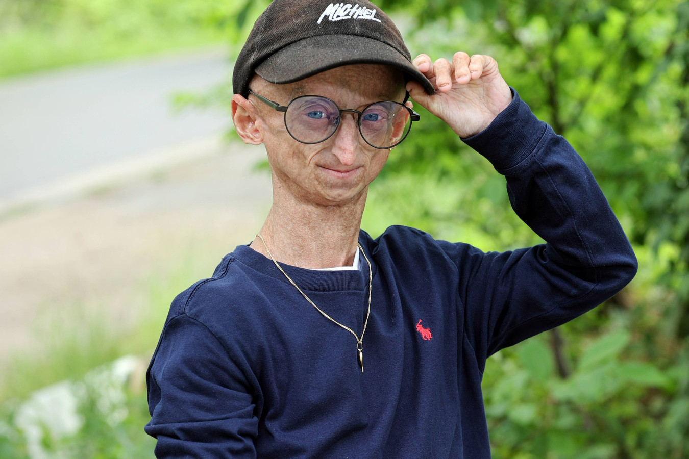 “Voor de operatie moesten ze mijn ribben breken”: progeria-patiënt ...