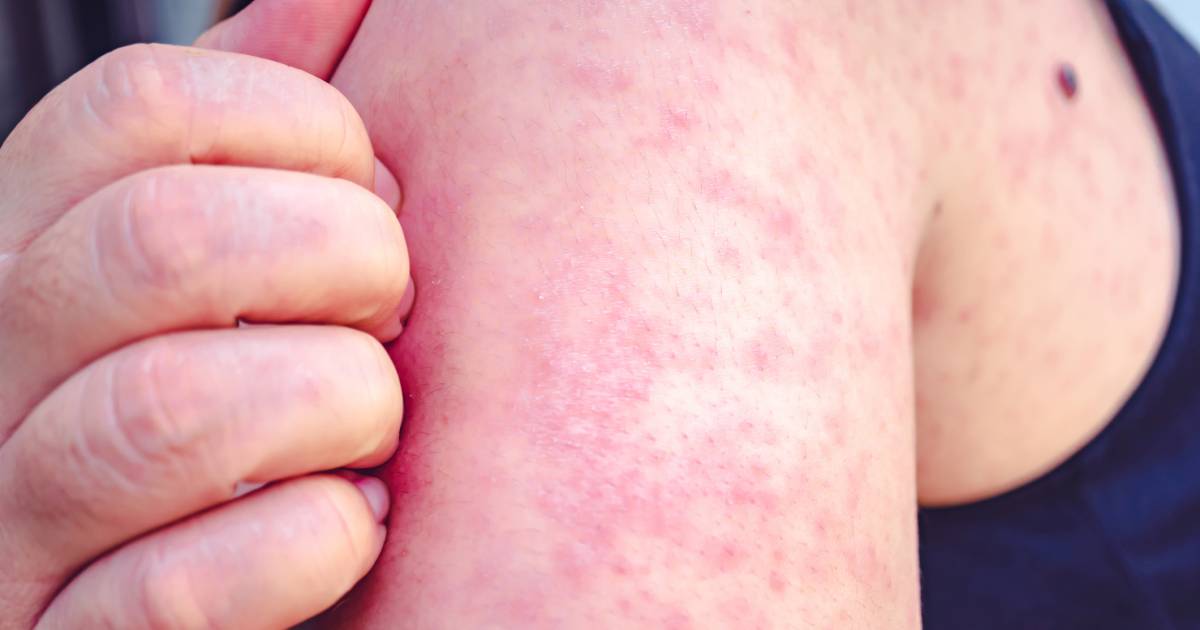 Man in de Achterhoek is besmet met ‘kinderziekte’ mazelen: wat weten we ...