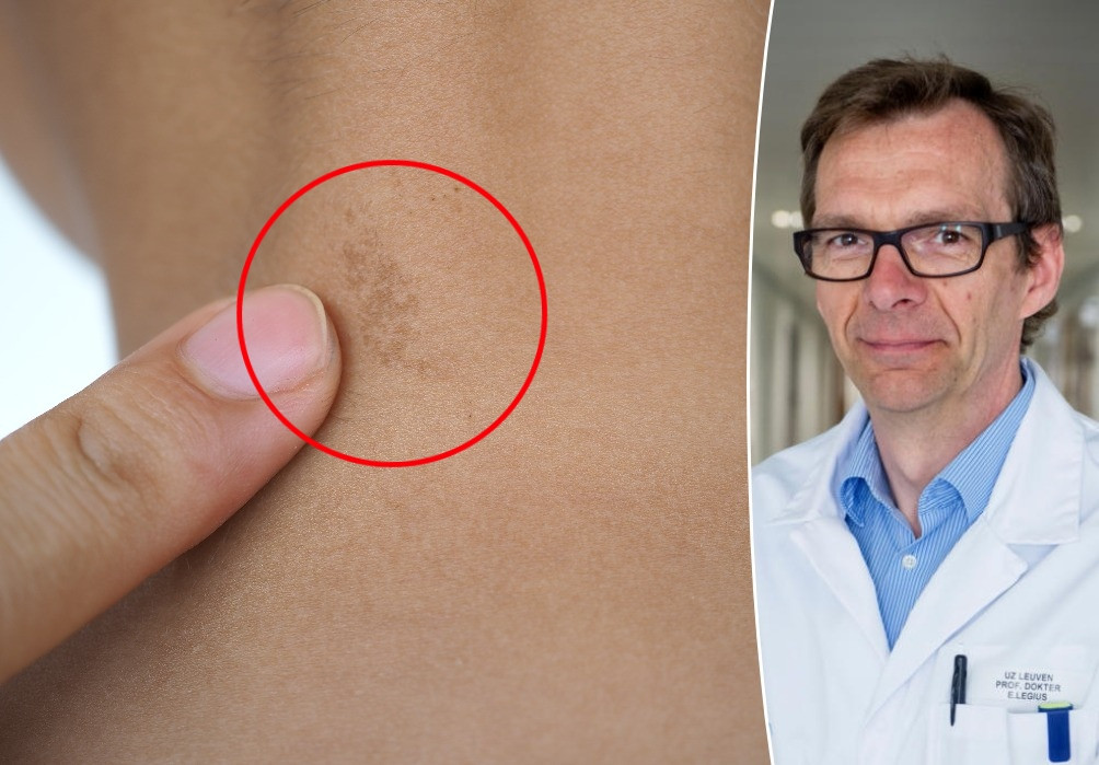 “Neurofibromatose is weinig gekend, maar niet zo zeldzaam”: wat is deze ...