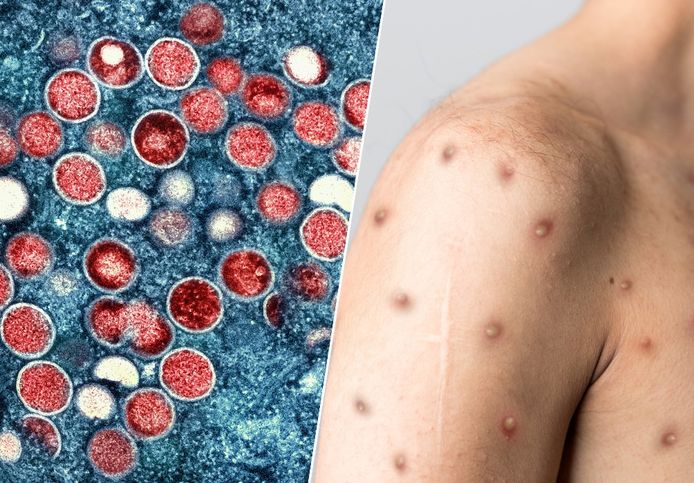 Wereldwijd 934 nieuwe gevallen van apenpokken in juni: noodtoestand ...