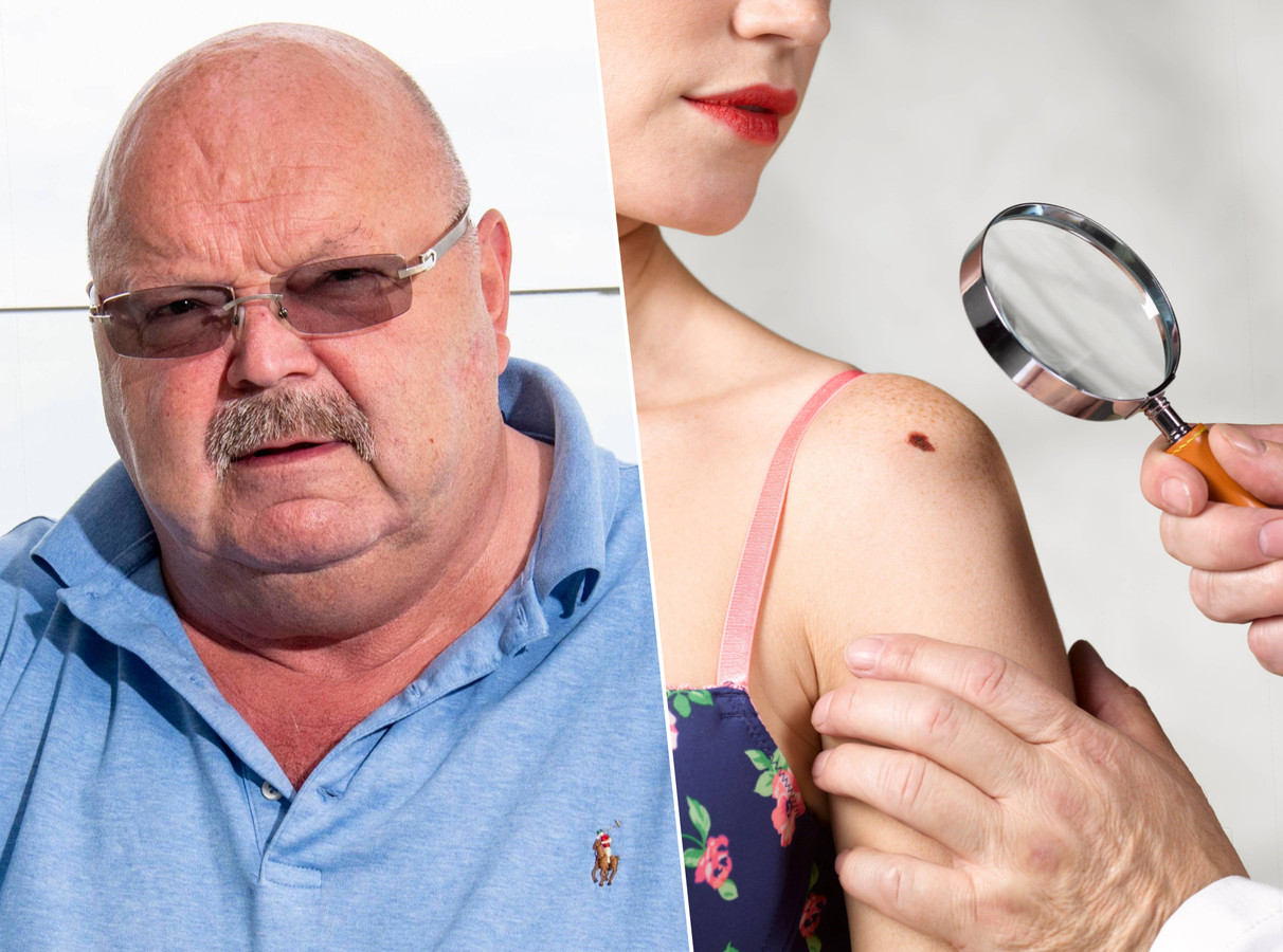 Huidkanker vastgesteld bij Michel Van den Brande: hoe herken je zelf ...