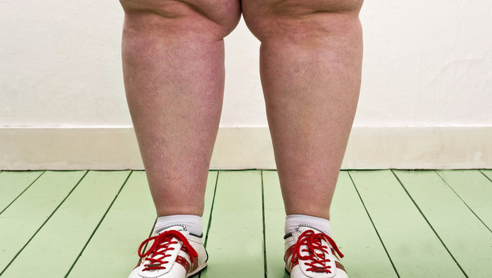 'Verwijderen overtollig vel ex-obesitaspatiënt moet vergoed ...