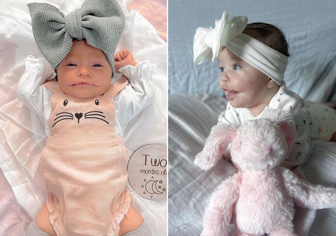 Cette fillette est née avec un sourire permanent dû à une malformation ...