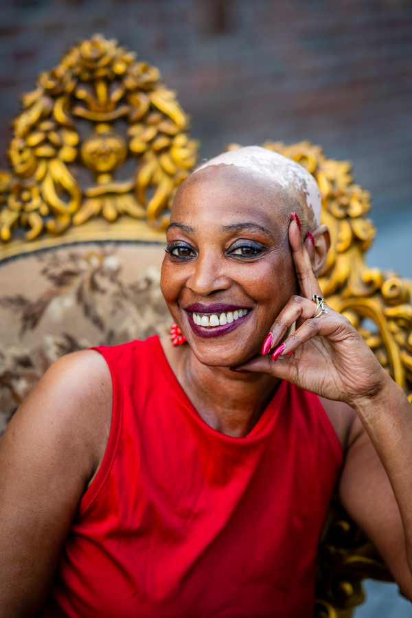 De ziekte die Vlamingen plots kaal maakt. Zij hebben alopecia: “Het ...