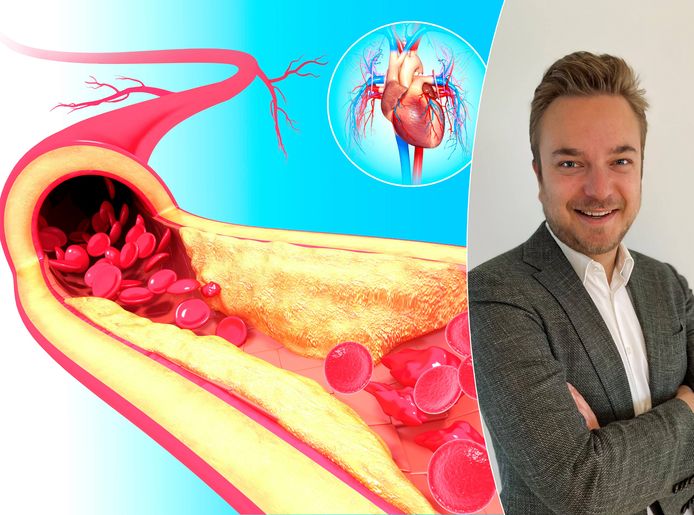 Cardiologen vragen verplichte screening slagaderverkalking: “Meer doden ...