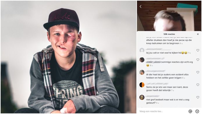 “Ben je te lang op de barbecue blijven liggen?”: zwaar verminkte Joeri ...