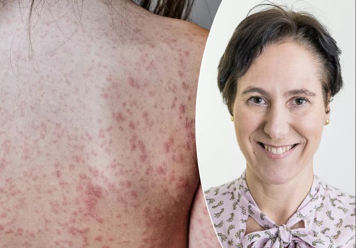 “Vlekken die opduiken en snel weer verdwijnen, duiden op netelroos en ...