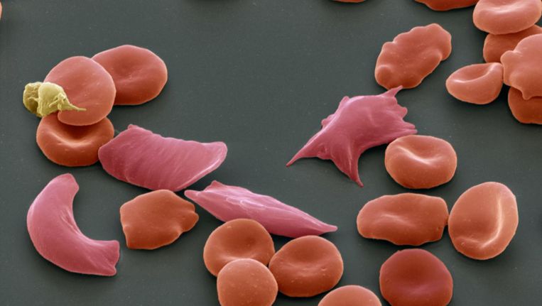 'Klein mijlpaaltje' in behandeling sikkelcelziekte | De Volkskrant