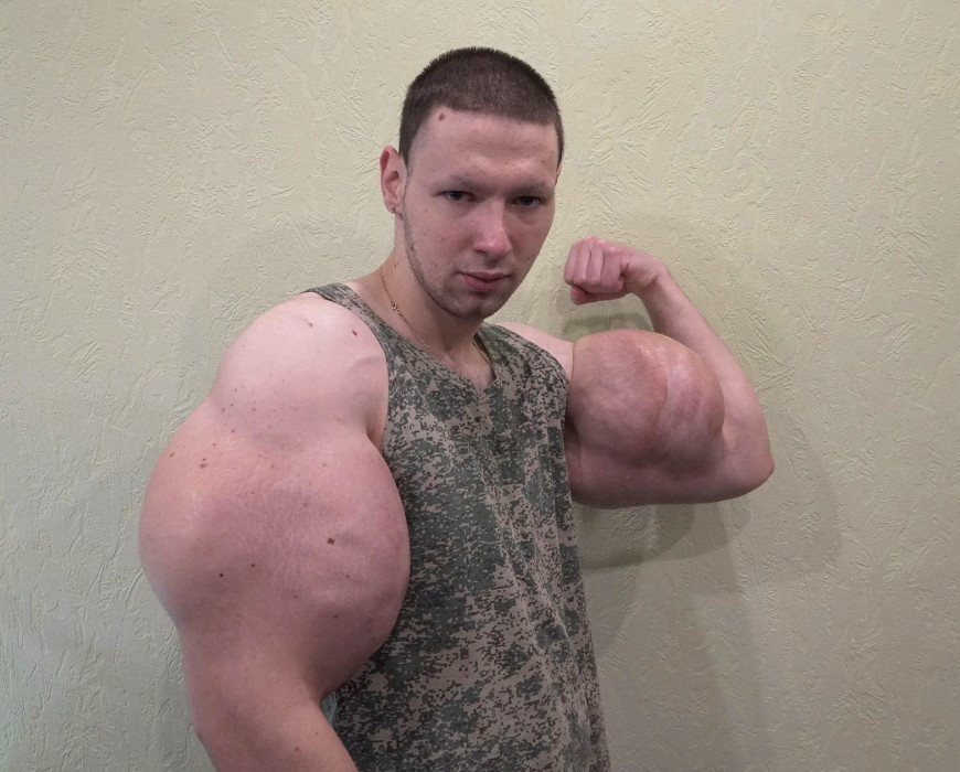 Popeye-bodybuilder wil af van met olie gevulde megabiceps | Foto ...