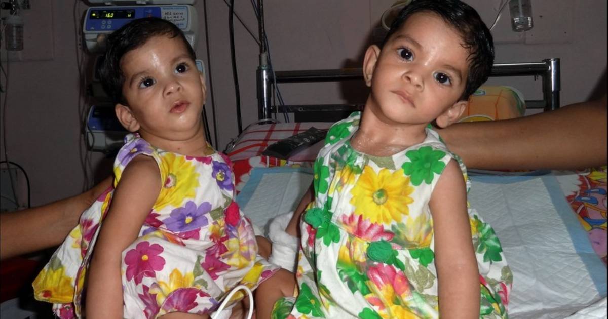 Meisje van Siamese tweeling in India gestorven | Buitenland | hln.be