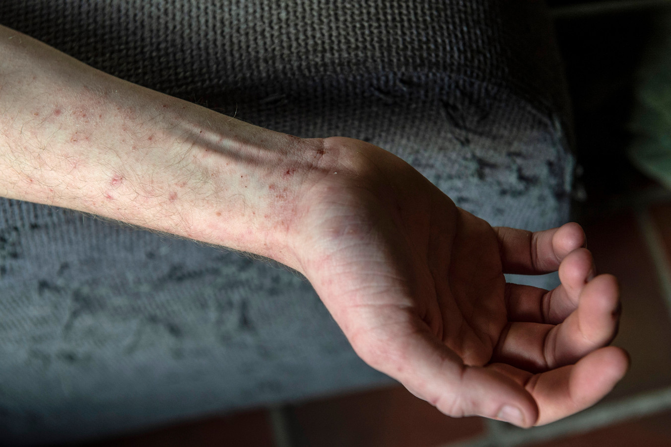 Schurft groeit artsen boven het hoofd: ‘Huilende mensen op spreekuur ...