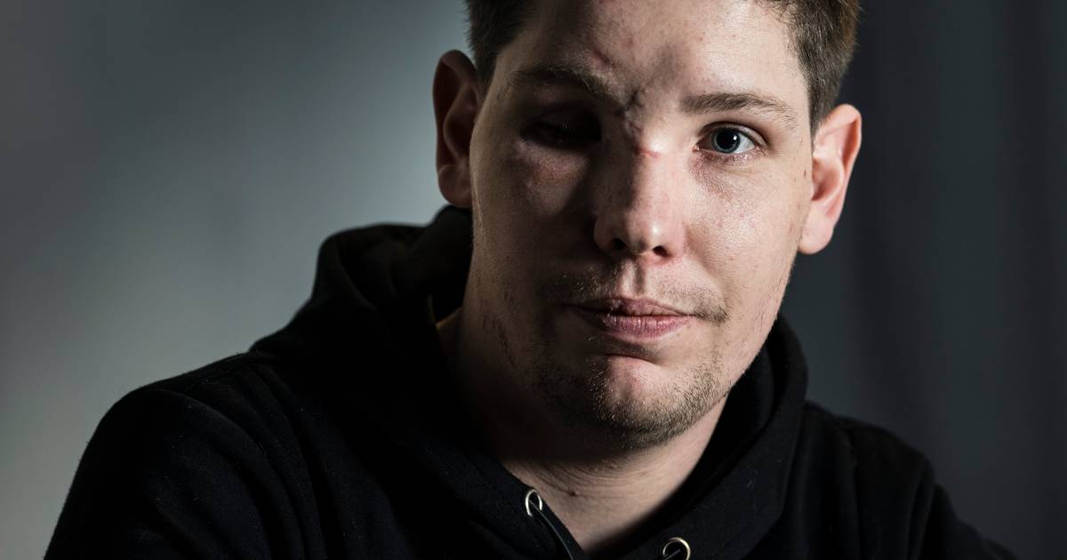 Lars (26) voor het leven getekend door ontplofte vuurwerkbom in zijn ...