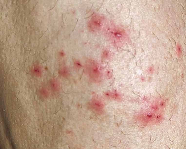 San Francisco en New York: ‘Apenpokken gevaar voor volksgezondheid’