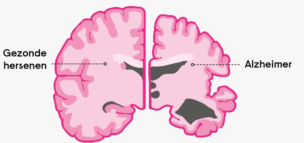 Een klant met dementie? Zo leert Arie (73) de kapper, kassière en biebmedewerker hoe daarmee om ...
