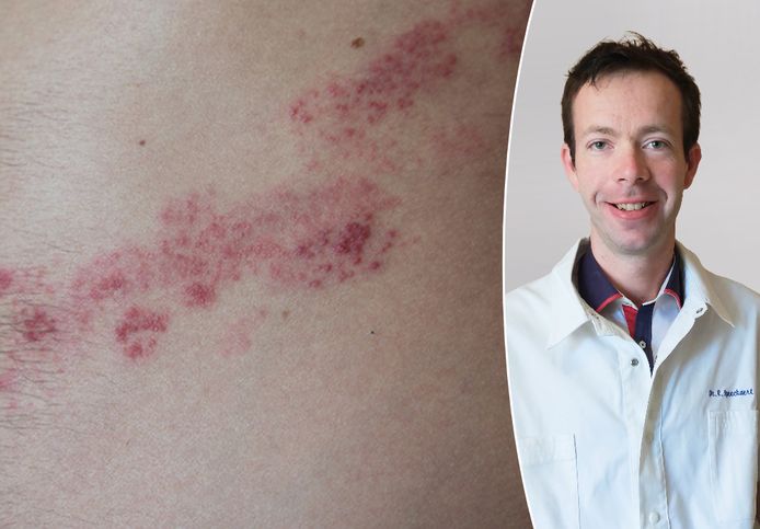 “Krijg je zona op je gezicht, ga dan onmiddellijk naar de spoed of je ...