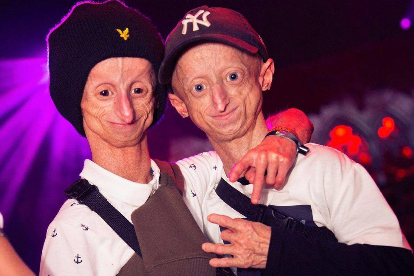 “Voor de operatie moesten ze mijn ribben breken”: progeria-patiënt ...