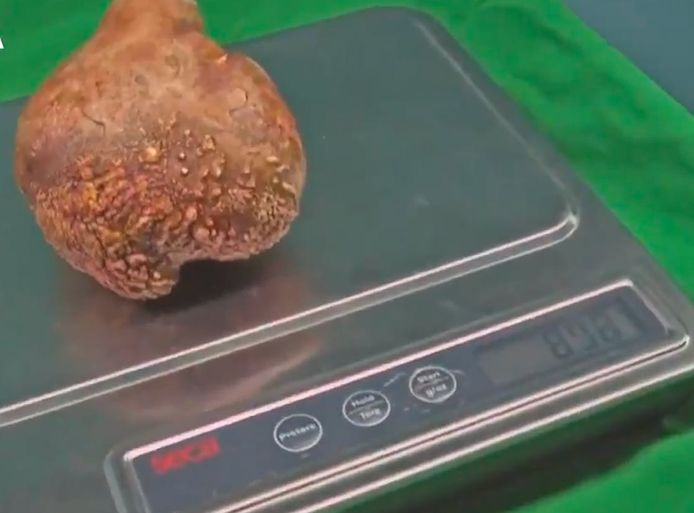 Video van de dag: Grootste niersteen ooit van ruim 13 centimeter ...