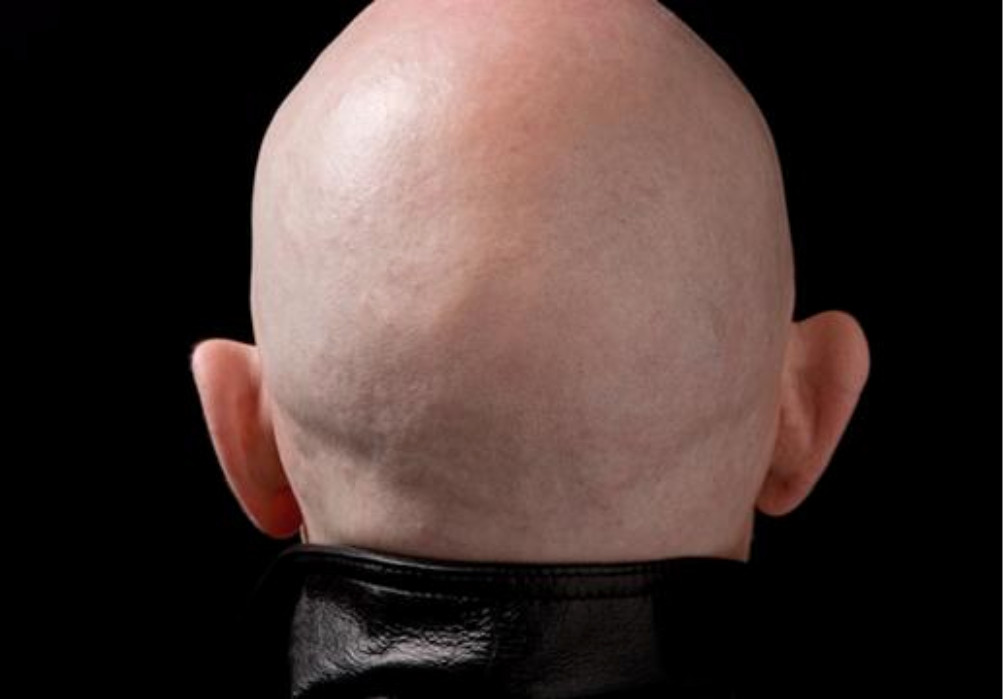 Man ‘kaal’ noemen op werkvloer is volgens Britse rechtbank seksuele ...