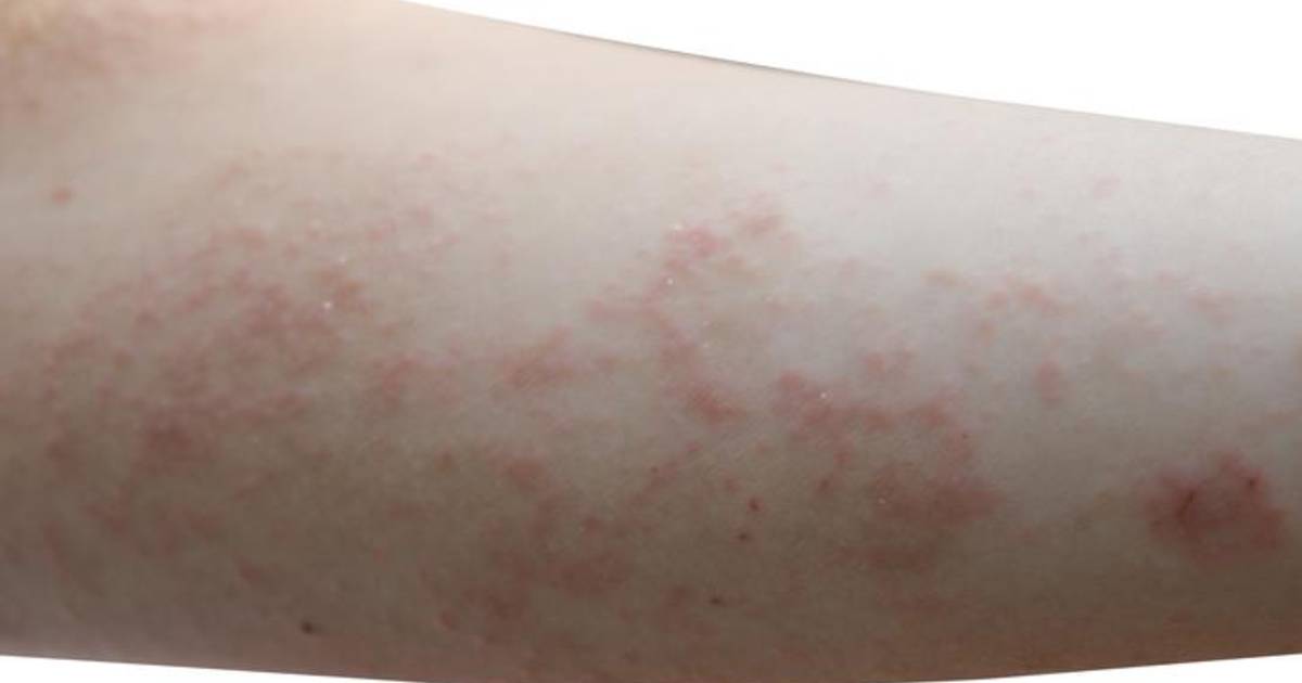 Épidémie de gale dans une école près de Marche | Santé & bien-être ...