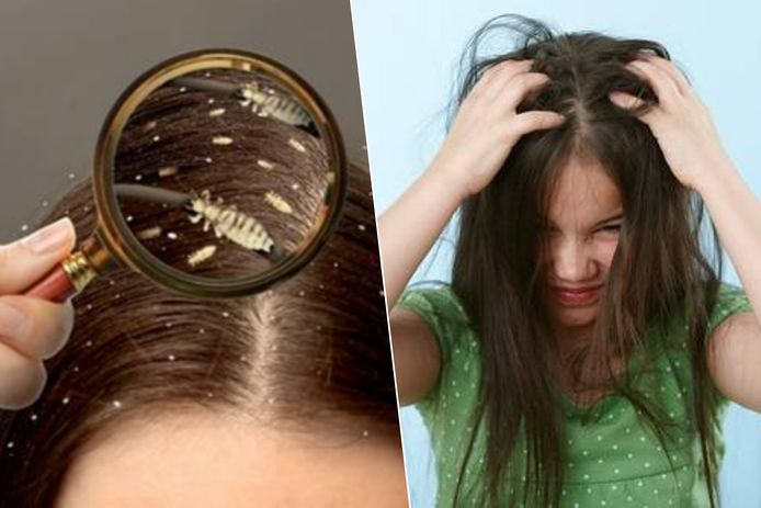 Niets lijkt nog te helpen tegen luizen, behalve ‘paardenmiddel van ...