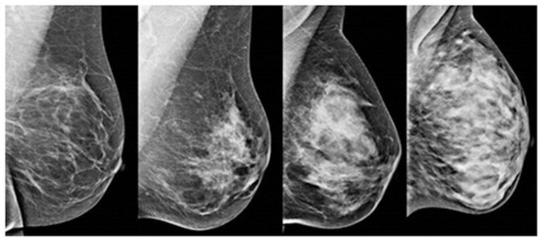 Hoe Vaak Mammografie: De Ideale Frequentie