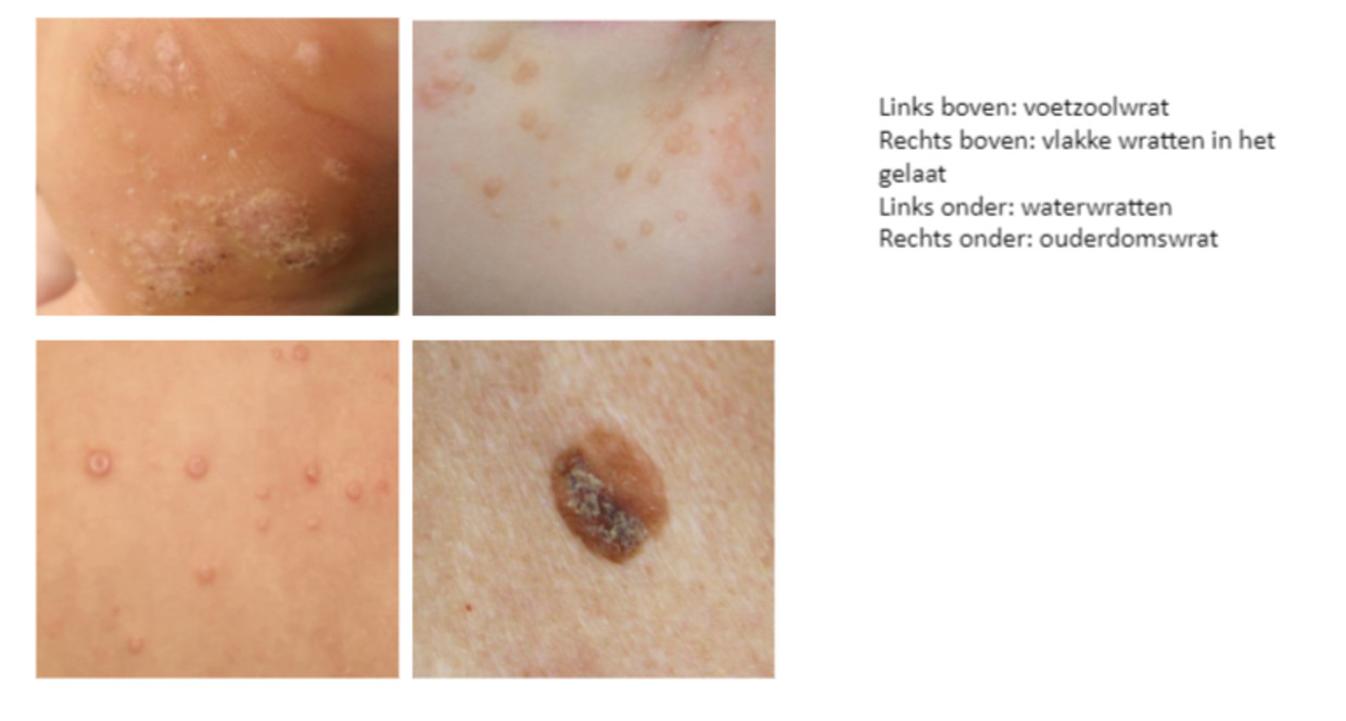 Zo vermijd je wratten, of raak je er weer van verlost: ‘Voorkom wondjes ...