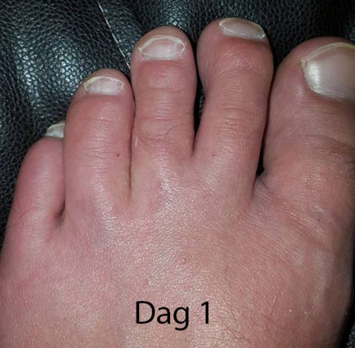 "Onze voeten zitten vol wormen": droomvakantie op Caraïben eindigt met ...
