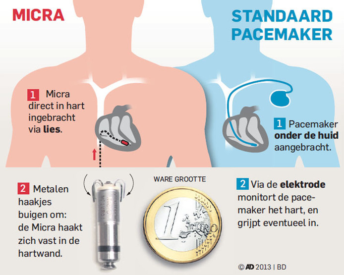 Mini-pacemaker veroorzaakt revolutie in medische wereld | Gezond | AD.nl