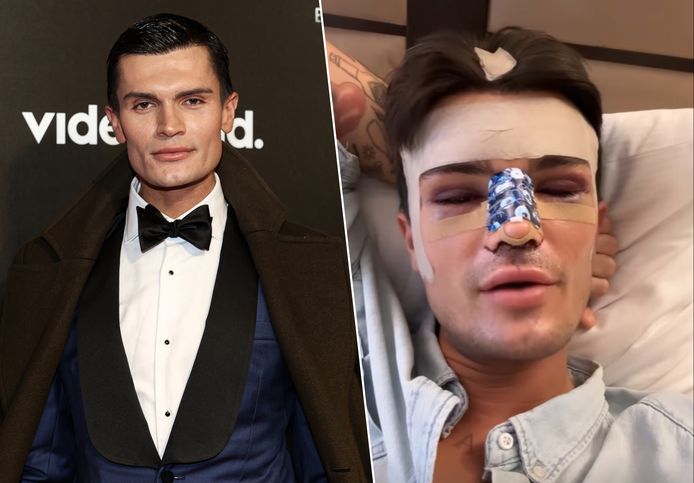 Nederlandse influencer Koen Kardashian vertelt over kapot gesnoven neus ... Nederlandse influencer Koen Kardashian vertelt over kapot gesnoven neus ...